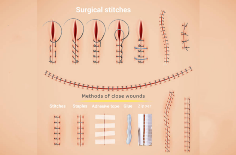 Adhesive tape, stitches, staples, zipper, glue: How to choose ... Adhesive tape, stitches, staples, zipper, glue: How to choose ...