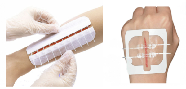 Adhesive tape, stitches, staples, zipper, glue: How to choose ...