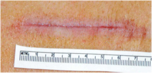 Liquid Bandage: Your Ultimate Wound Care Companion - PerfectSeal