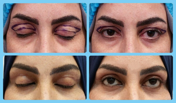 Sculpting Perfection: Application of Surgical Glue in Cosmetic Plastic ...