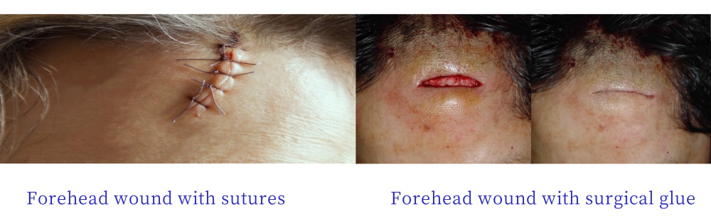 Surgical Glue Mistake VS Correct Use - PerfectSeal