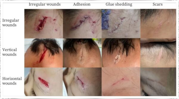 Comprehensive Guide to Lacerated Wound Treatment - PerfectSeal