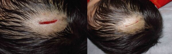 Comprehensive Guide to Lacerated Wound Treatment - PerfectSeal