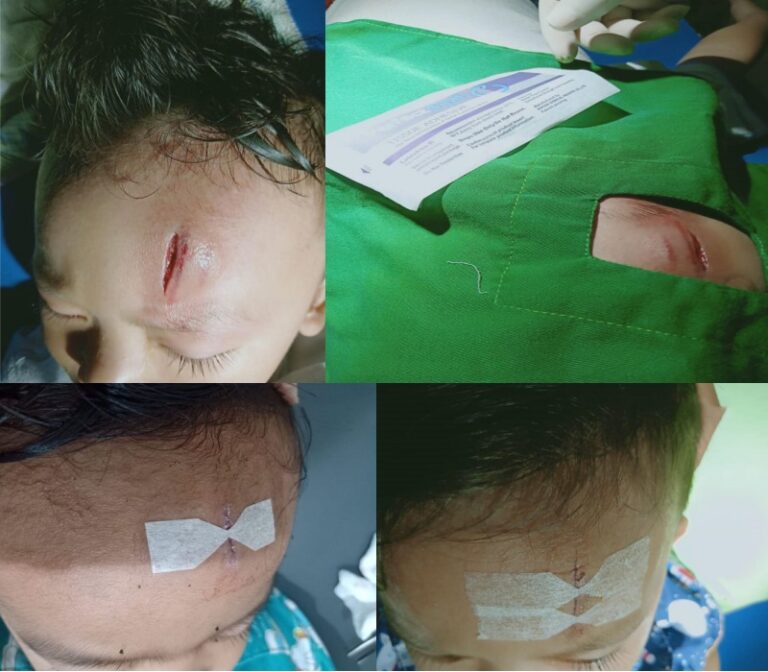 Comprehensive Guide to Lacerated Wound Treatment - PerfectSeal