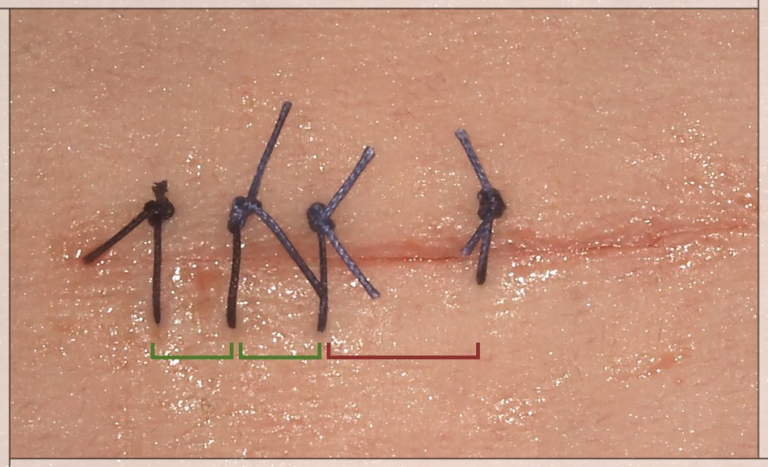 Types of Suture Techniques: Traditional VS Cosmetic Methods - PerfectSeal