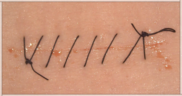 Types of Suture Techniques: Traditional VS Cosmetic Methods - PerfectSeal