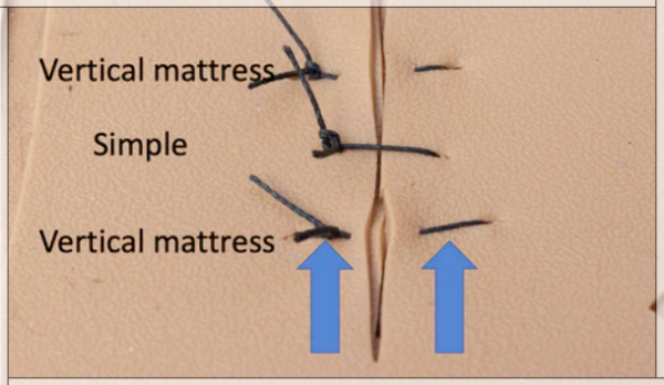 Types of Suture Techniques: Traditional VS Cosmetic Methods - PerfectSeal